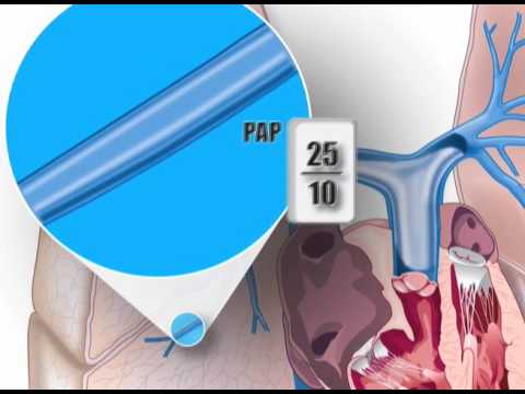 livingwithph.ca - PA SPASM
