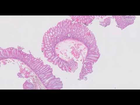 Common epithelial polyps of the colon