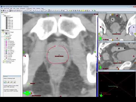 Contouring Prostate Prostate Plus Seminal Vesicles