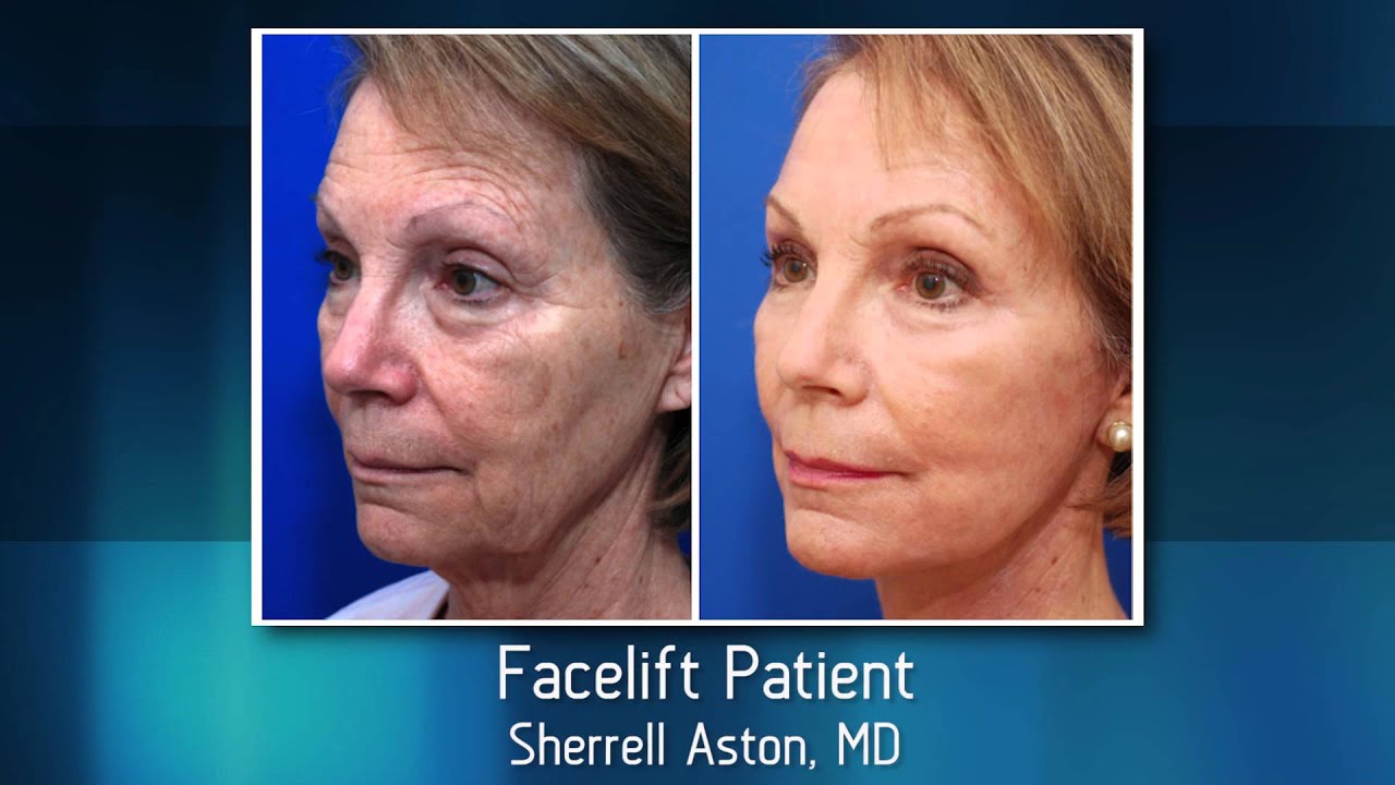 You Can Achieve Natural-Looking Facelift Results with This Technique
