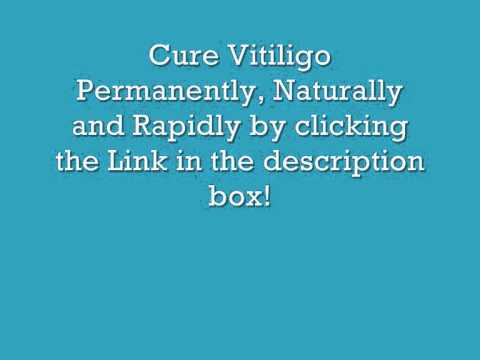 Vitiligo Treatment - Natural Vitiligo Treatment System Review