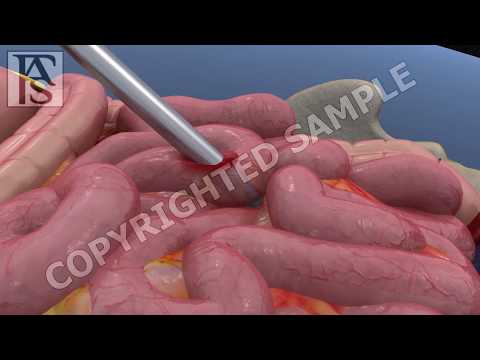 Laparoscopic Bowel Puncture