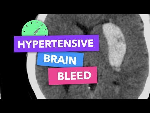Hypertensive brain bleed - Radiopaedia's Emergency Radiology Course