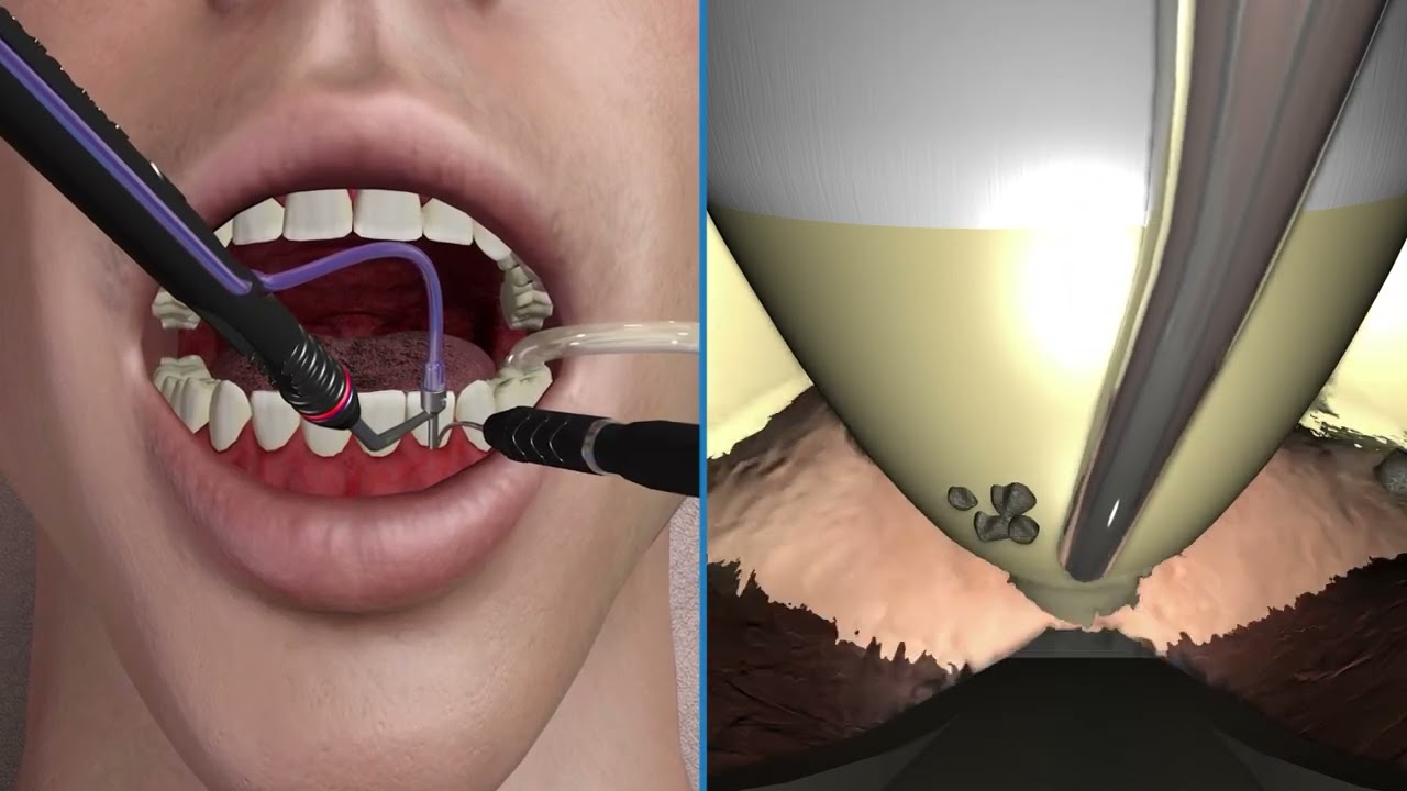 PerioView® Dental Endoscope Features and Benefits