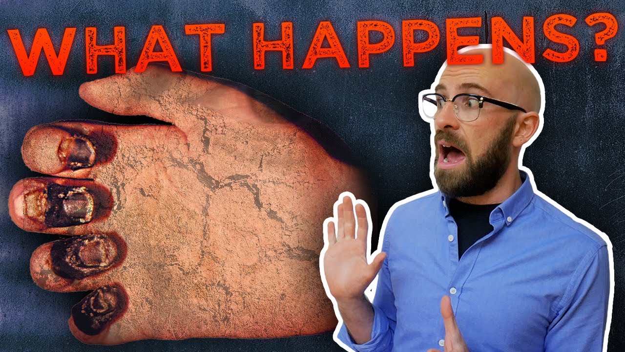 Does Leprosy Actually Make Your Fingers and Toes Drop Off?