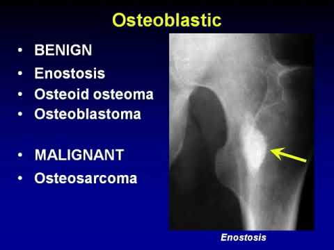 Bone Neoplasms, # Bone