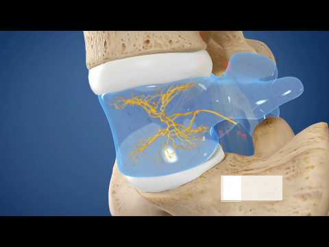 The Relievant Intracept Procedure