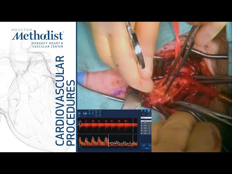 Extended CEA for Common Carotid Disease (Alan B. Lumsden, MD, Zsolt Garami, MD)