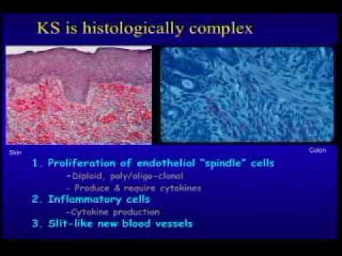KSHV Infection & the Biology of Kaposi's Sarcoma