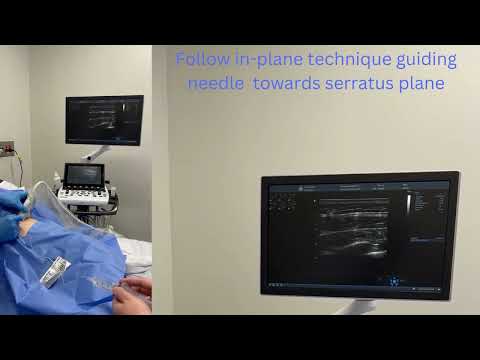 Serratus Anterior Plane (SAP) Nerve Block for rib fractures – Frankston ...