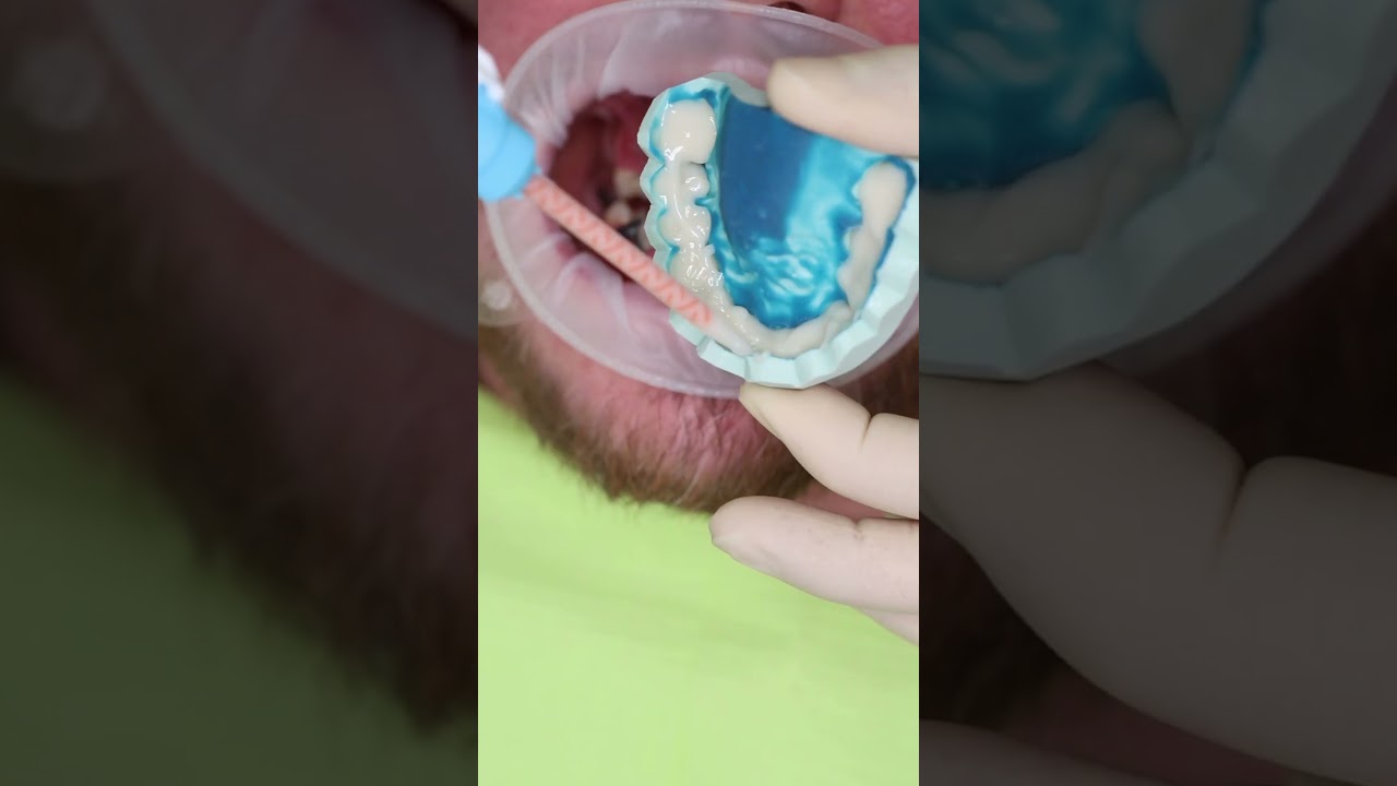 Wax up All on 4 in Prague #shorts #dentist #dental #implant #veneers #short