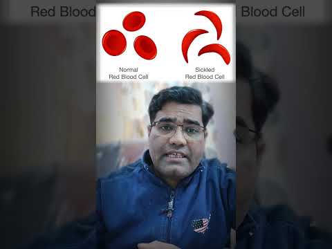 Sickling blood टेस्ट क्या है ? #shorts #sicklingtest #sicklecellanemia