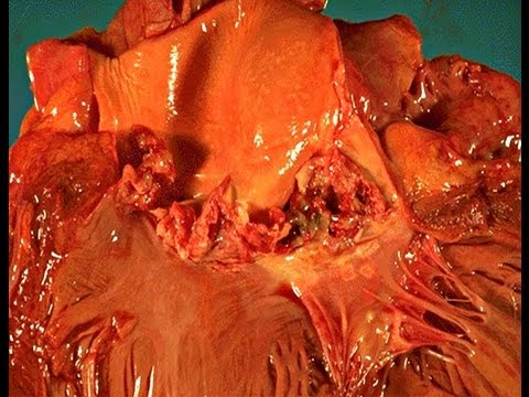 Infective Endocarditis - Medical PowerPoint Presentation