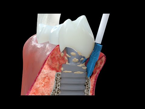 Labrida Webinar - Advancing Periodontal and Peri-Implant care