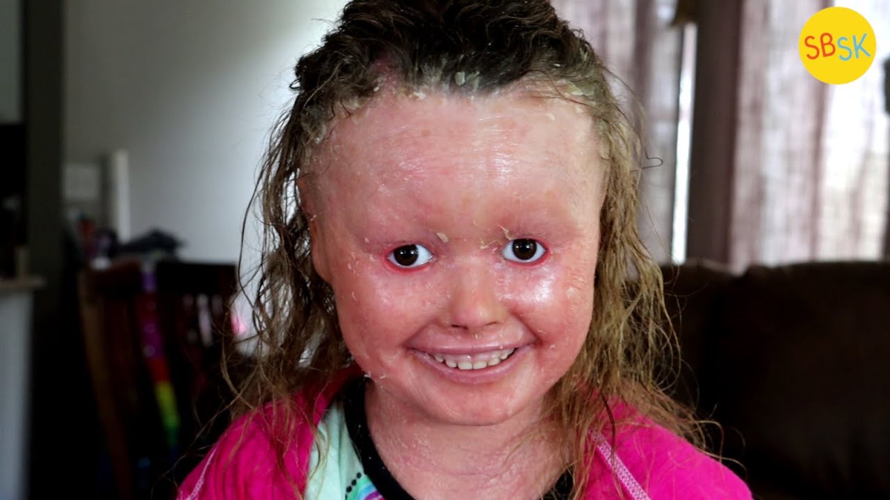 Living with Harlequin Ichthyosis (Skin that Grows 10x Too Fast)