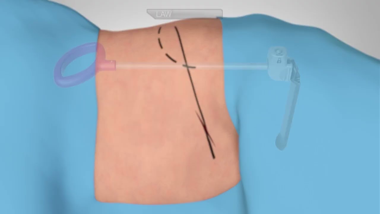 XALIF™ - Procedural Technique