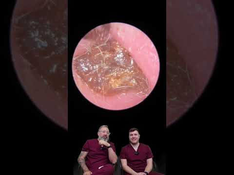 HARD AS A ROCK! Deep Ear Wax Plug Removal ๐ฑ๐