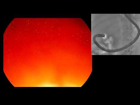 Florida Live Endoscopy Educational Video || Tips for single-step transgastric EUS and ERCP