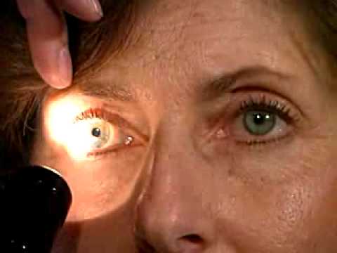 Neurologic Exam Cranial Nerves Normal : Cranial Nerves 2 & 3- Pupillary Light Reflex