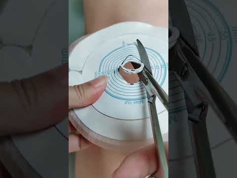The shape of the stoma is not round, oval and irregular, how to cut the stoma bag