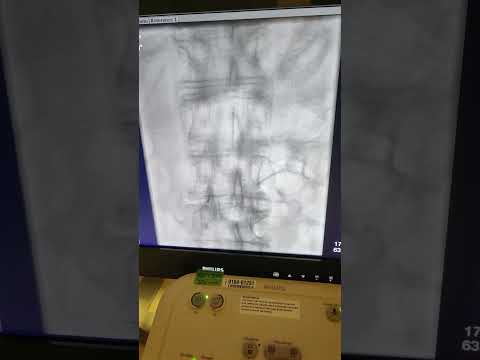 IABP torturous aorta