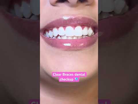 Visit www.thedocrok.com for clear braces consultations 💎