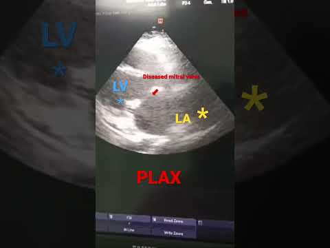 PLAX and PSAX for mitral valve pathology #cardiology #echocardiography #clinic #mrcp