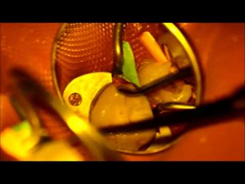 Syndenta cinema: zubní kazy v kvadrantu