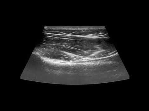 Appendix K Axillary Deltoid Nerve Block