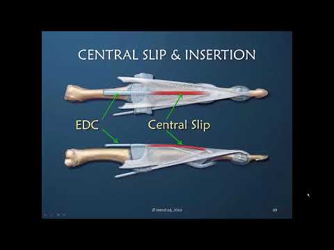 Understanding the Dorsal Apparatus of the Finger; Part 5 of 11: EDC Insertions