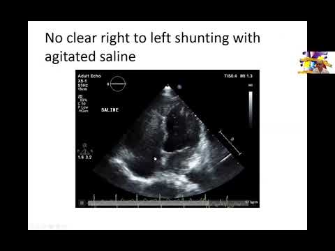 Rare form of Atrial Septal Defects and Review of ASDs