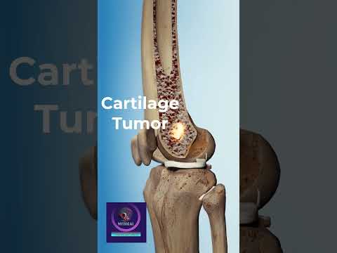 Cartilage Tumor #3D Animation #shorts