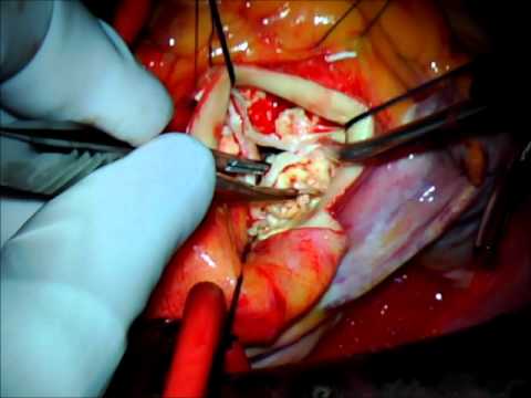 Evaluating Heavily Calcified Aortic Valve.wmv