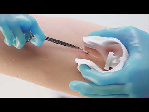 Ilmarinen Engineering LLC- Juna Medical Implant