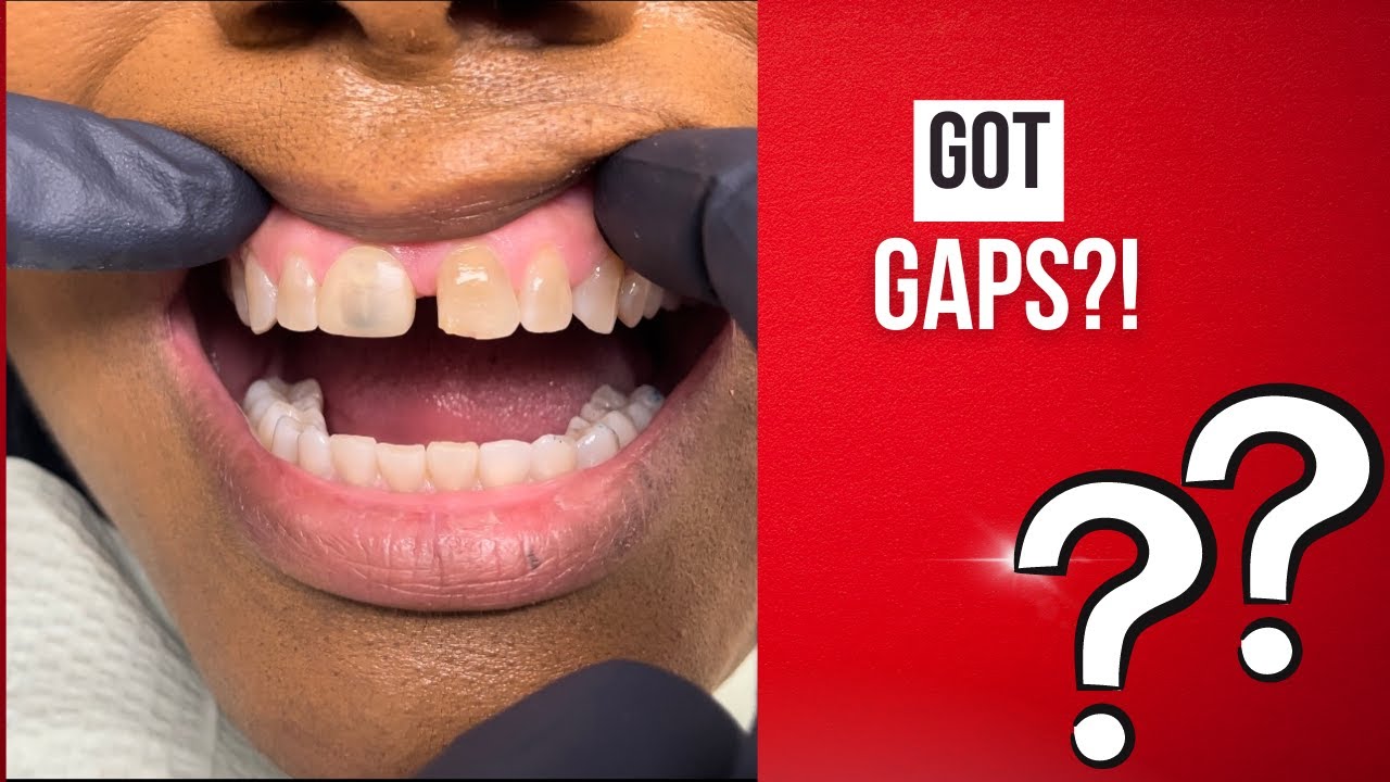 Got Gaps between your front teeth?? Hate to smile?? You won't believe this easy solution!