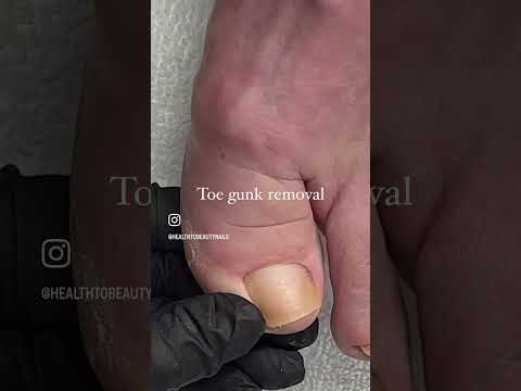 Toe gunk removal *satisfying* #deadskin #pedicure #satisfyingvideo #toenails #cleannails