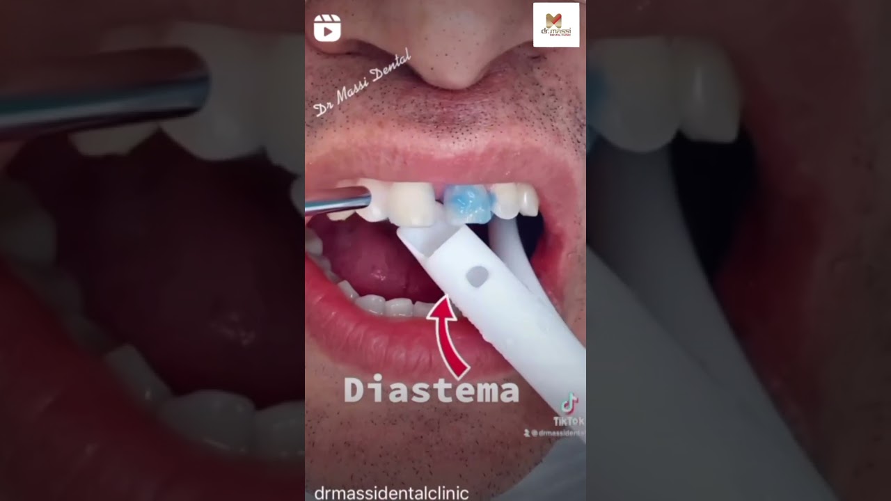 How to close the gap in front teeth?