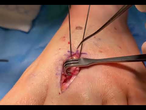 Osteotomy for Freiburg’s Infraction - follow up to the intra-operative diagnosis video