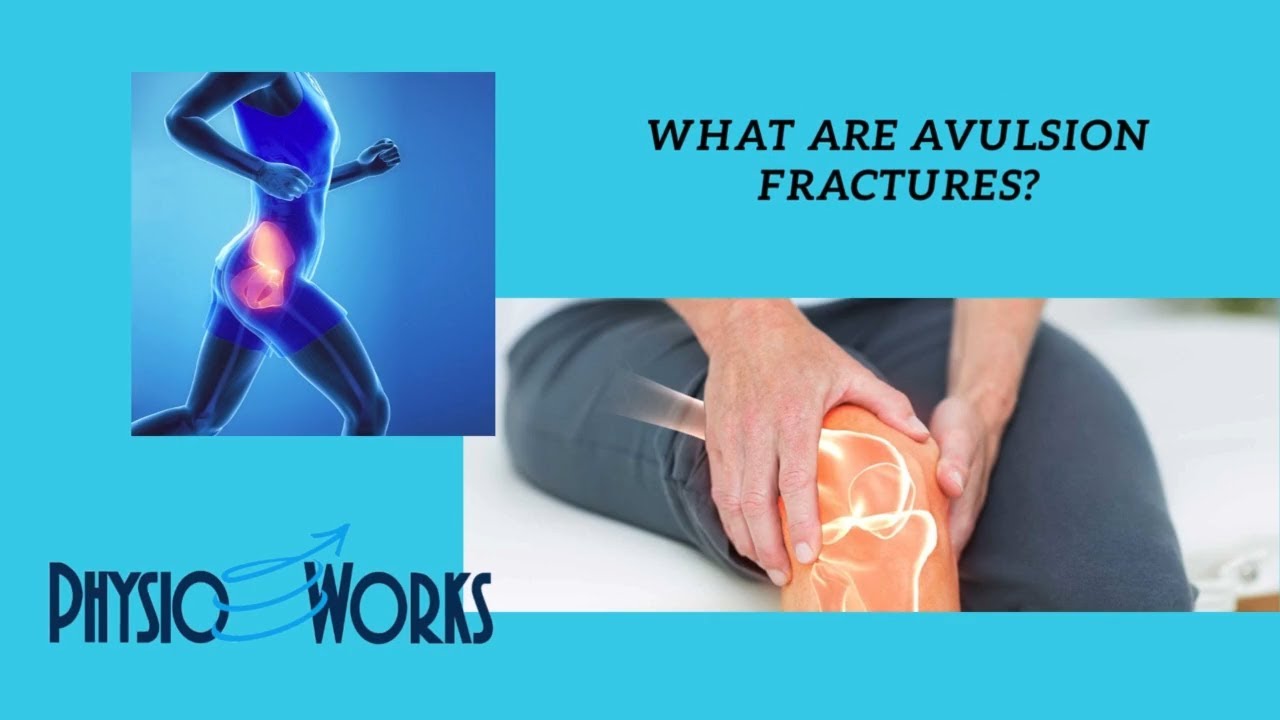 What is an Avulsion Fracture?