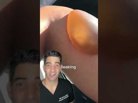 Blisters, should you pop them?