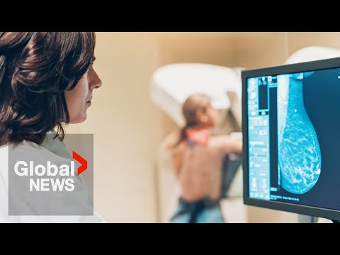 Breast cancer screenings should start at age 40, experts advise