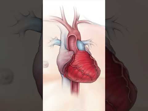 PreOp® Coronary Angioplasty with Stent Placement - Patient Education #shorts