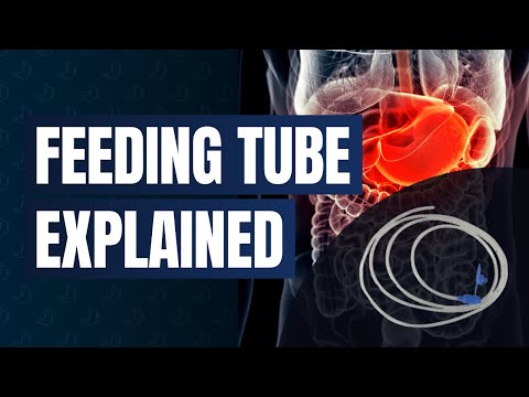 Feeding Tube