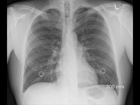 Silent Hypoxia and COVID-19
