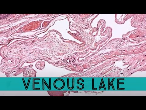 Venous Lake under the microscope (pathology dermpath dermatology dermatopathology)