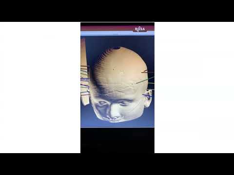 BRAINterns 7/13 - Dr. Shaun Rogers (Pediatric Neurosurgery Virtual OR)