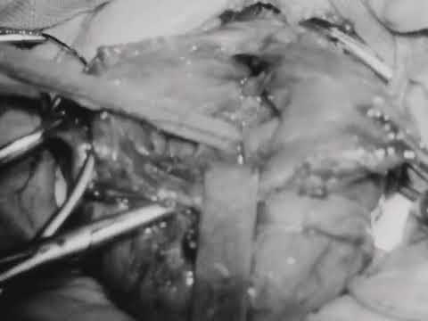 Multiple Diverticula of the Bladder [Silent] (Petrolagar Laboratories, 1929)