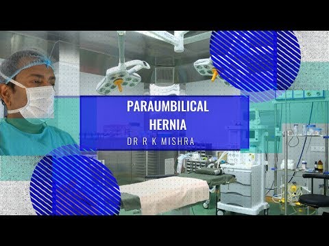 Laparoscopic Umbilical Hernia Mesh Repair (IPOM Plus) • Video • MEDtube.net