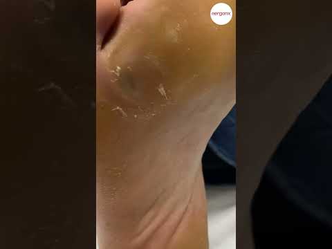 Deep corn removal from the ball of the foot