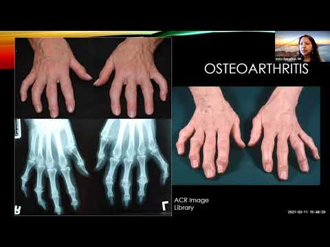 CHRC - Investigating Joint Pain